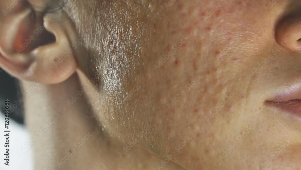 Woman Getting a Beauty Injection in her neck and decollete area. Young ...