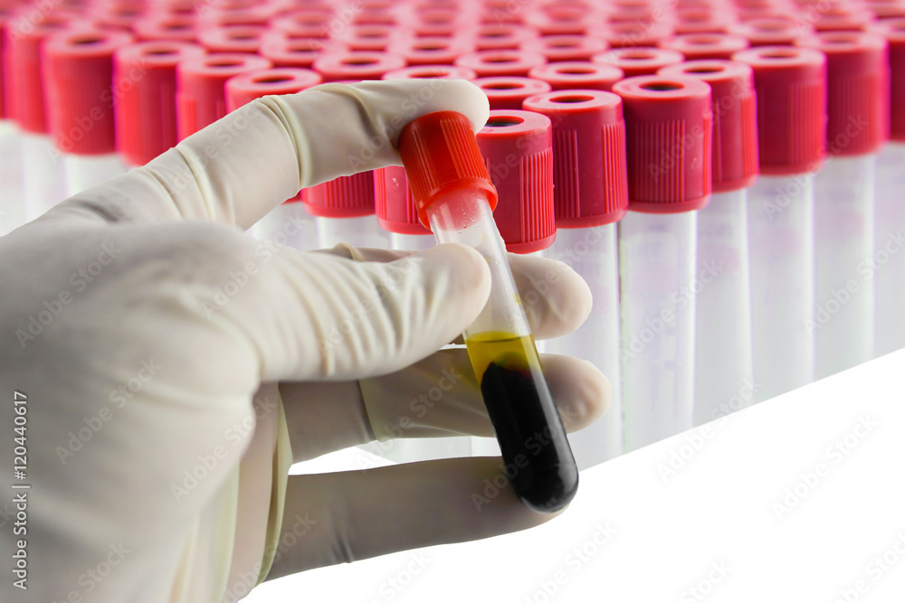 Hand holding test tube with blood plasma ready for testing isolated on ...