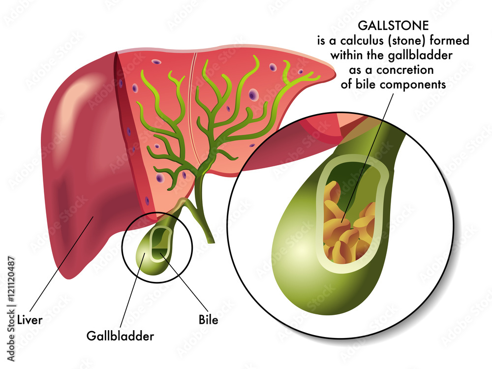 gallstones Stock Vector | Adobe Stock