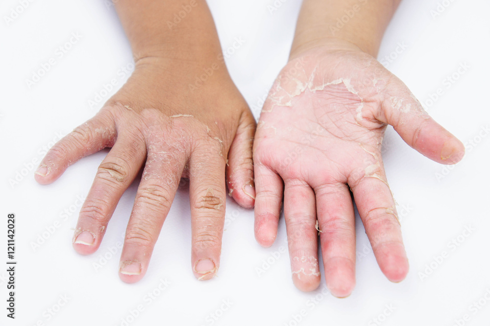 Dry hands, peel, Contact dermatitis, fungal infections, Skin inf Stock ...