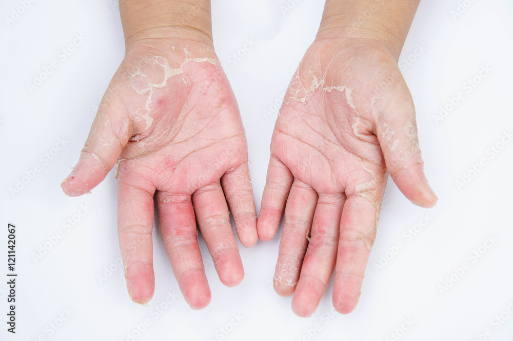 Dry hands, peel, Contact dermatitis, fungal infections, Skin inf Stock ...