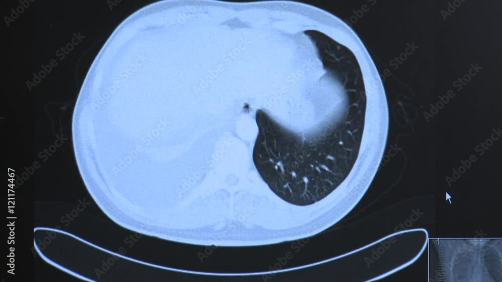 Anonymous chest x-ray CT scan results (Filmed in ProRes with high ...