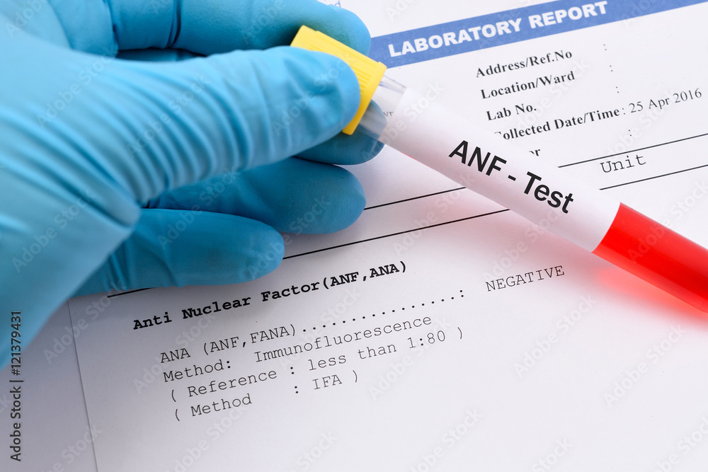 Blood sample with antinuclear factor (ANF) result, autoimmune diagnosis ...