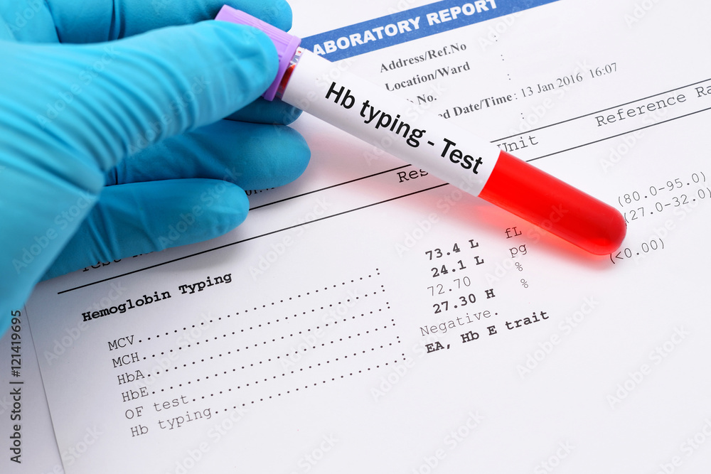 Blood sample with abnormal Hb typing result, Hb E trait Stock Photo ...
