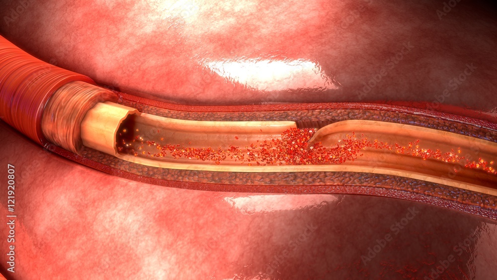 Artery Dissection Stock Illustration | Adobe Stock