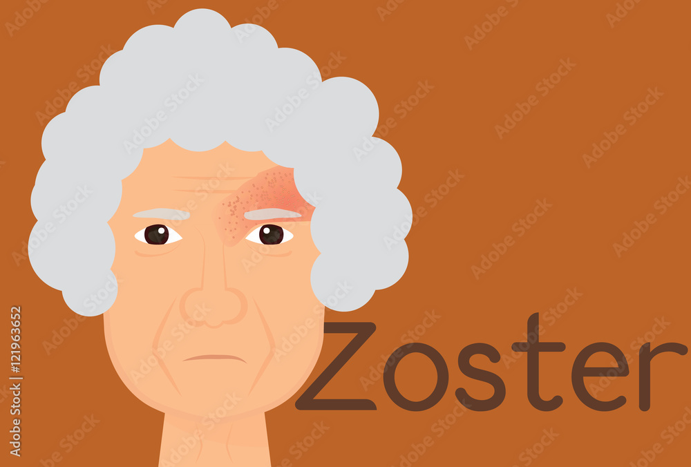 Old woman suffering from shingles. Herpes zoster illustration. Stock ...