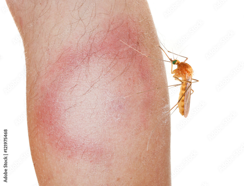 An Erythema Migrans rash often seen in the early stage of Lyme disease ...