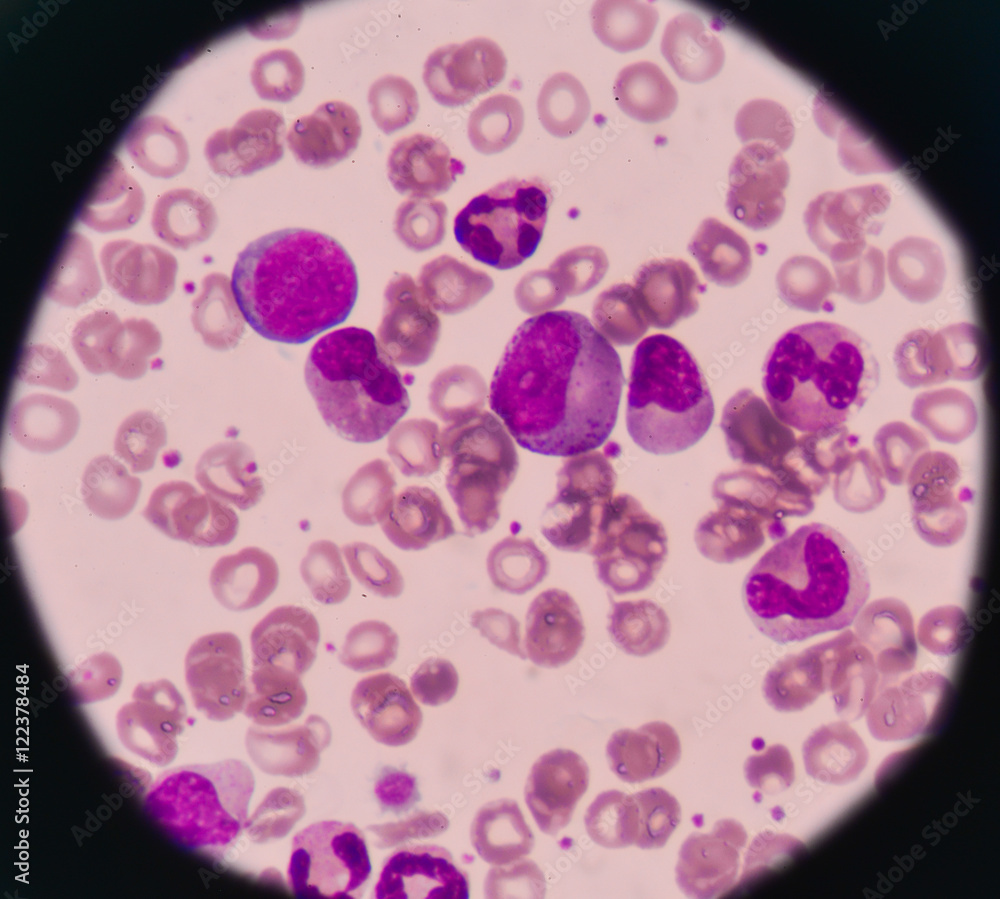 blood smear is often used as a follow-up test to abnormal result Stock ...