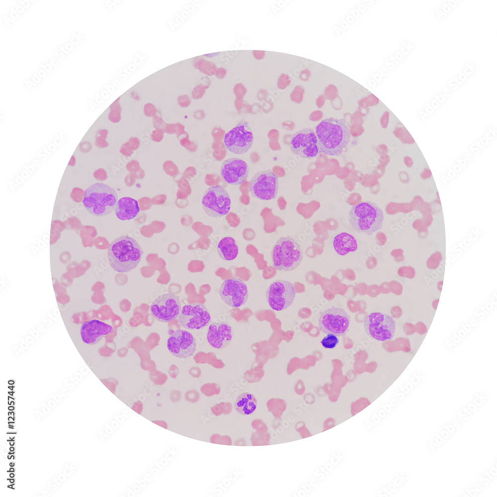 Microscopic view of a blood smear from leukemia patient showing ...