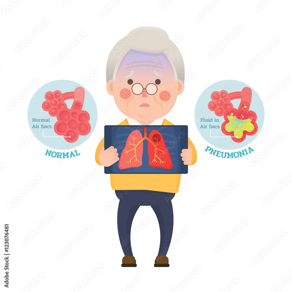 Vector Illustration of Old Man Holding X-ray Image Showing Lung ...