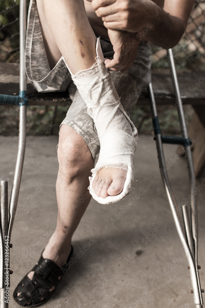 broken leg in a cast male Stock Photo | Adobe Stock