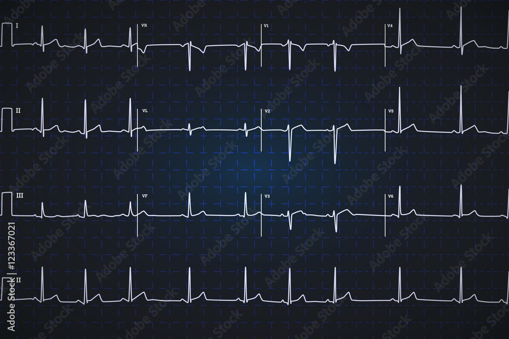 Typical human electrocardiogram, white graph on dark blue background ...