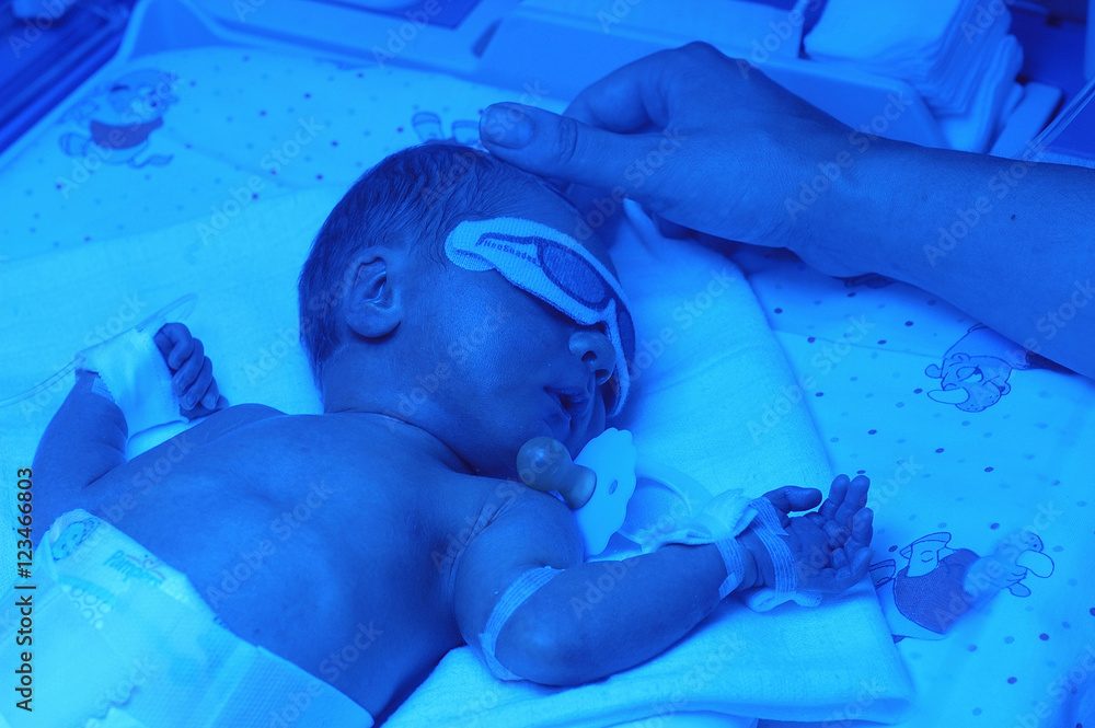Newborn having a treatment for jaundice under ultraviolet light in ...