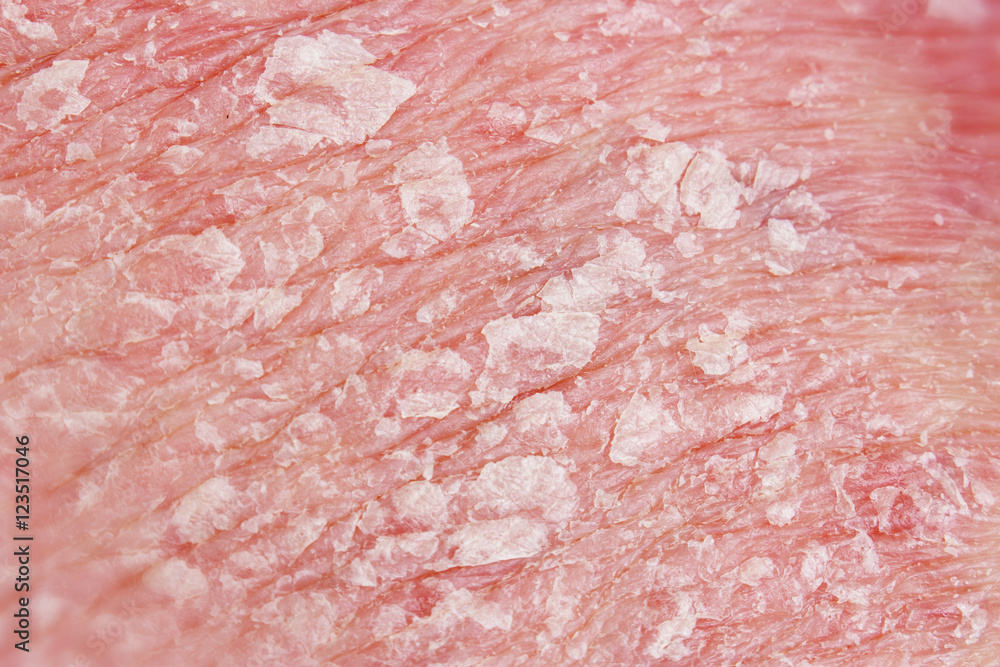 Psoriasis, psoriatic skin disease is red, itchy, and scaly, macro with ...