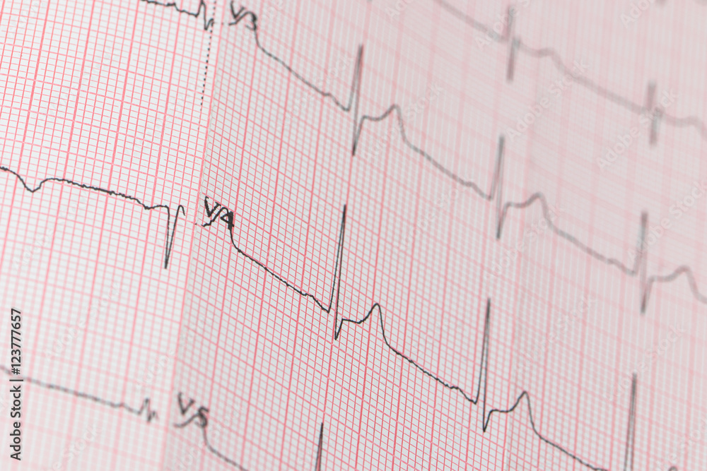Elektrokardiogramm EKG Aufzeichnung der Herzfrequenz Stock Photo ...