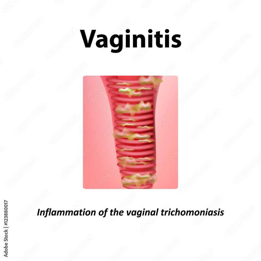 Trichomoniasis Vaginitis