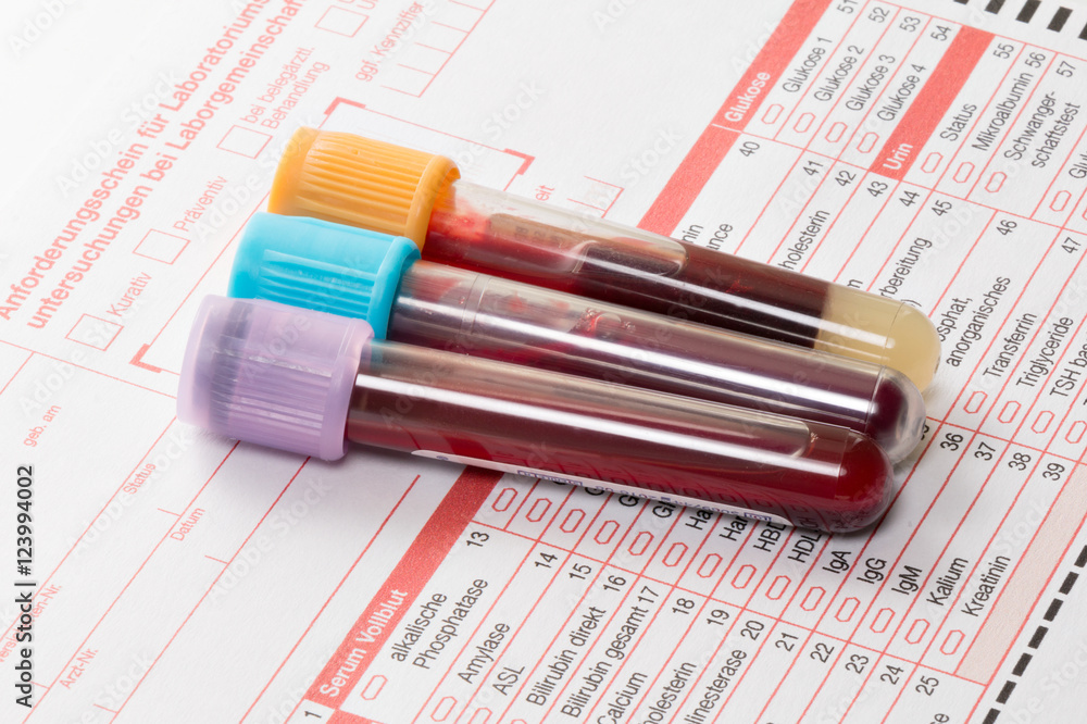 Blut Labortest,Blutuntersuchung, Blutproben auf einem Laborformular ...