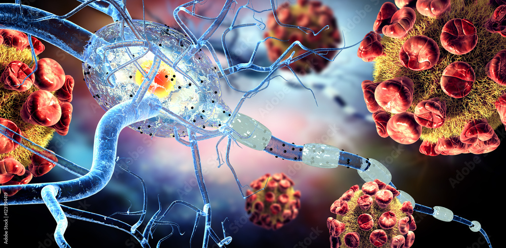 Damaged nerve cells, concept for neurodegenerative and neurological ...
