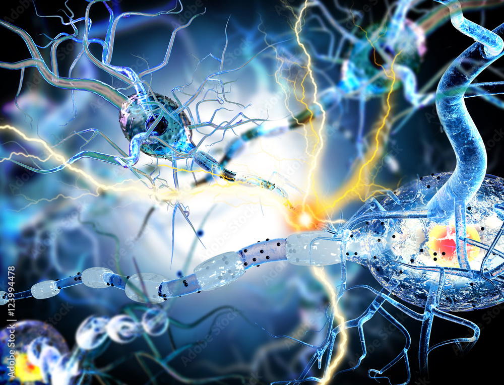 Damaged nerve cells, concept for neurodegenerative and neurological ...