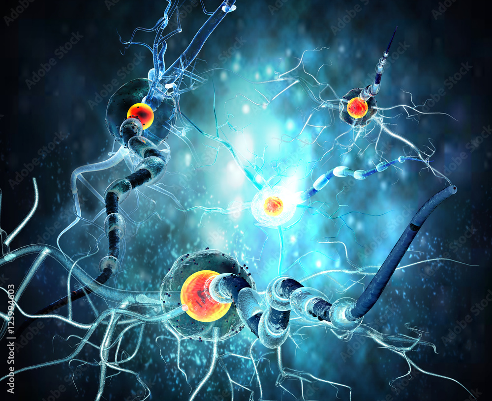 Damaged nerve cells, concept for neurodegenerative and neurological ...