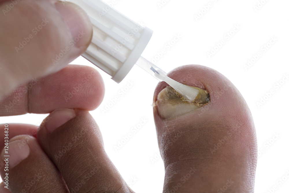 Applying polish on toenail suffering fungus infection isolated on white ...
