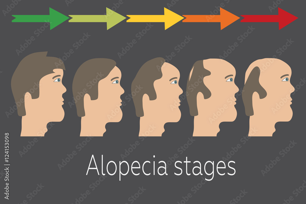 Alopecia stages set. Front view of a man losing hair. Male baldness ...