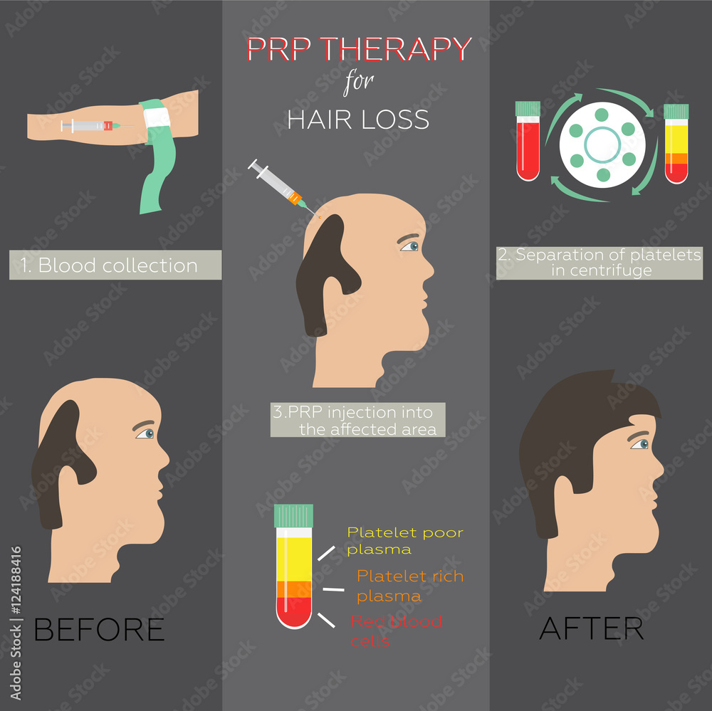 Platelet rich plasma injection. PRP therapy process. Male hair loss ...