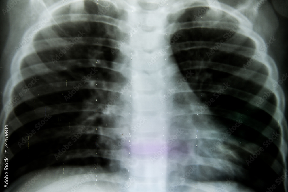 X-Ray Image Of Human Chest for a medical diagnosis Stock Photo | Adobe ...