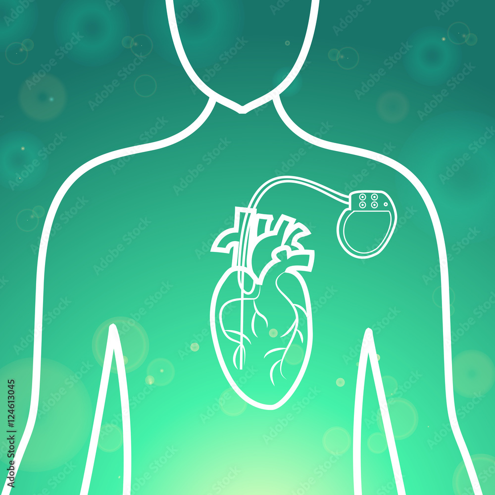 Heart with pacemaker medical wallpaper,vector illustration.Human Heart ...