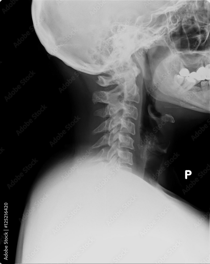 Foto de X-Ray or MRI - Magnetic Resonance Imaging of Spinal Column and ...