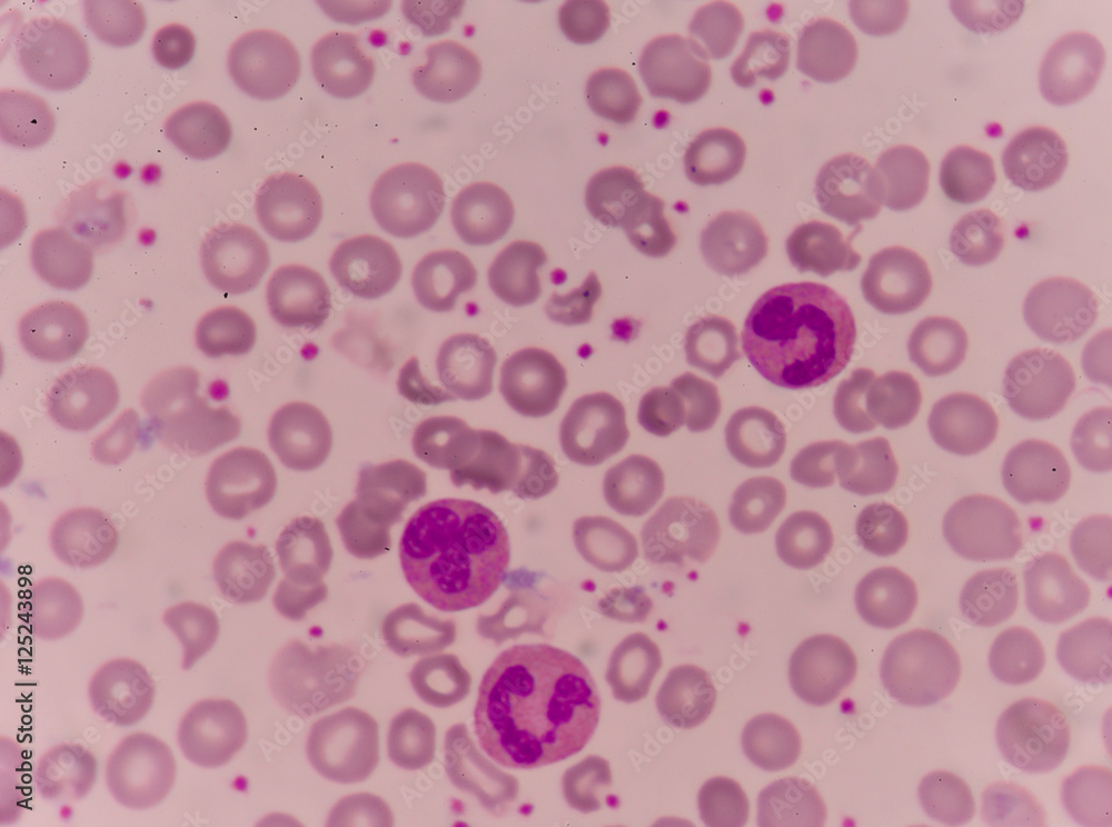 Band Neutrophils