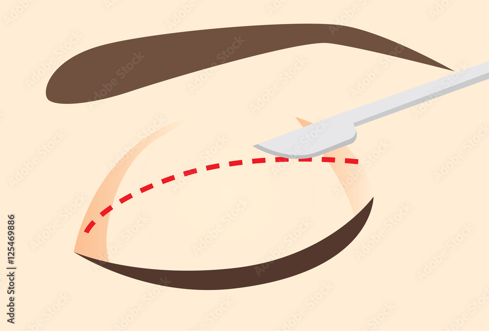 Knife on the eyelid along the designed incision line. Illustration ...