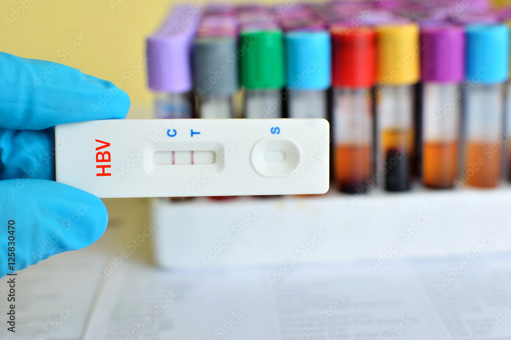 Rapid test cassette for hepatitis B virus (HBV) testing, the result ...