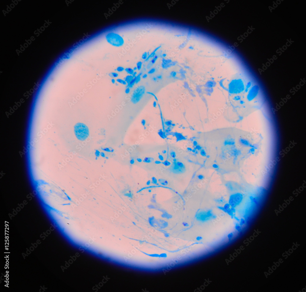 Pseudohyphae In Urine