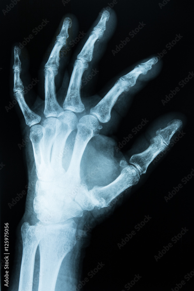 Linke Hand Röntgen Bild Aufnahme Stock-Foto | Adobe Stock
