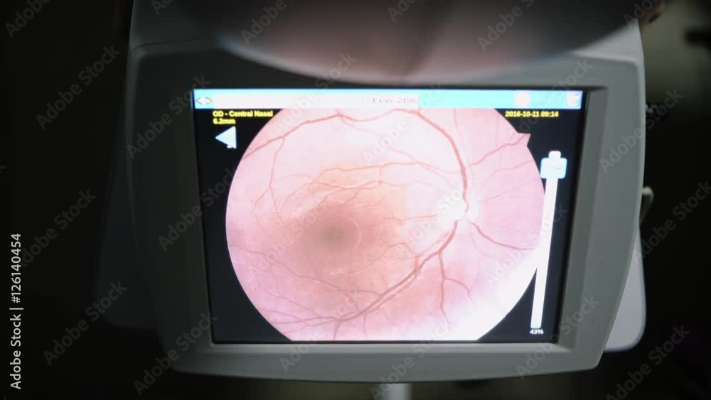 Eye test computer image of retina, showing optic disc cupping Stock ...