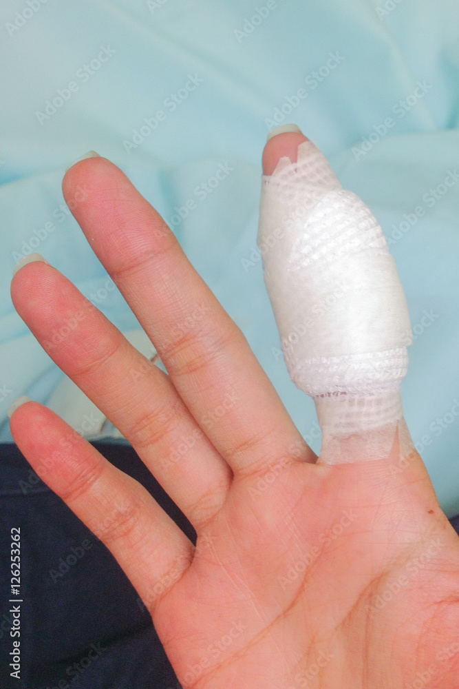 Cut the index finger, right hand and has been sewn and wrapped f Stock ...