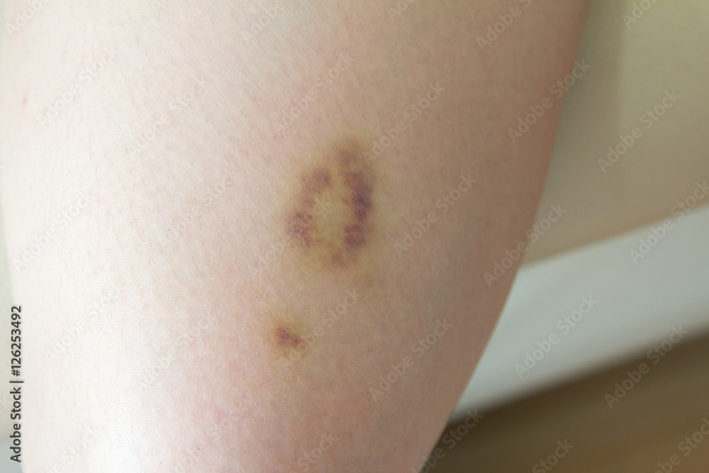 Closeup Bruise on wound woman leg skin Stock Photo | Adobe Stock