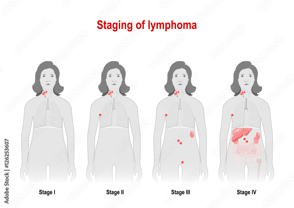 Staging of lymphoma. Woman silhouette with highlighted internal Stock ...