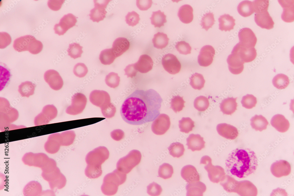 plasma cell human blood cell under microscope,complete blood count ...