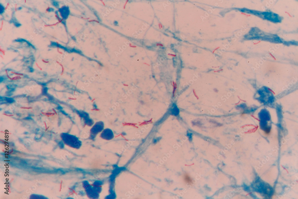 Mycobacterium Leprae Gram Stain