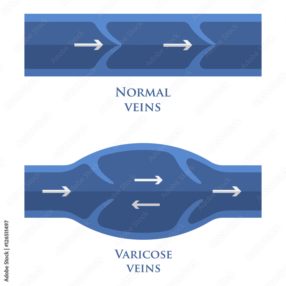 Vector illustration of a varicose vein and normal vein. Flat style ...