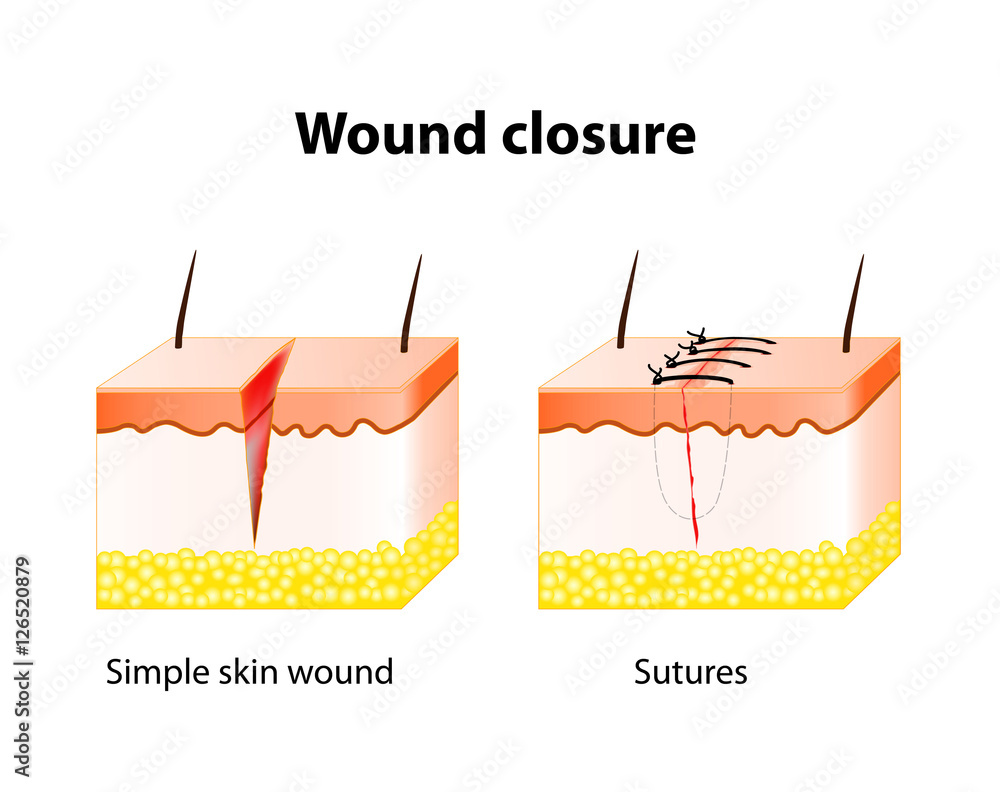 wound healing process with help surgical suture. Stock Vector | Adobe Stock