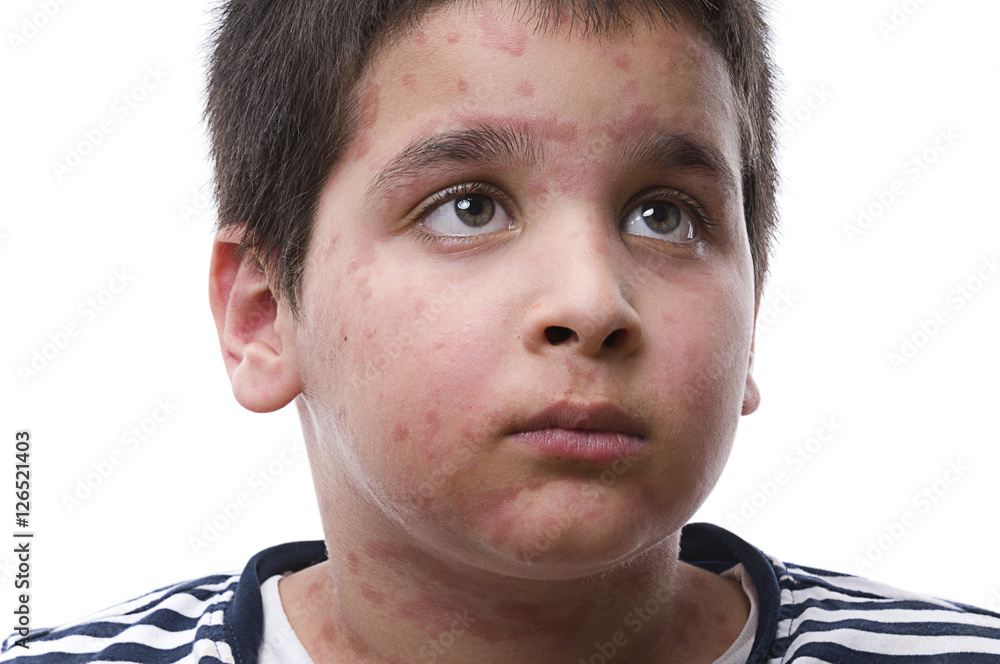 Urticaria Face Close up Stock Photo | Adobe Stock