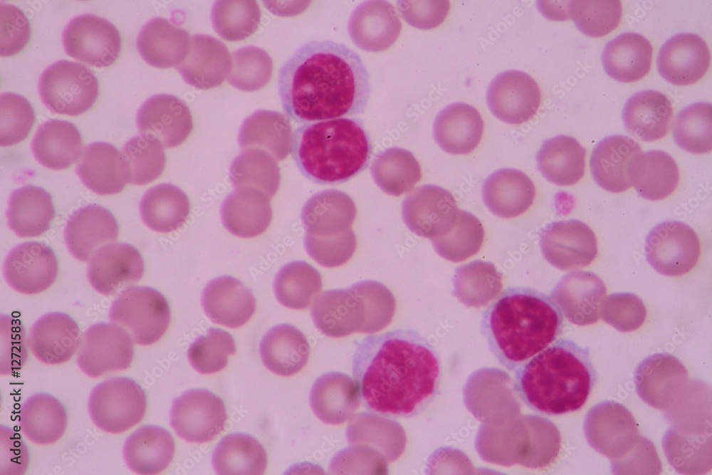 Blood smear shows large number of cancer leukemia cells(Blast cells ...