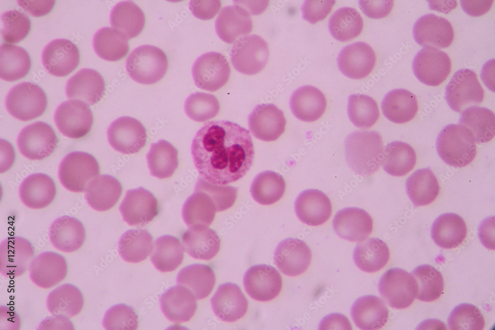 Blood smear shows large number of cancer leukemia cells(Blast cells ...
