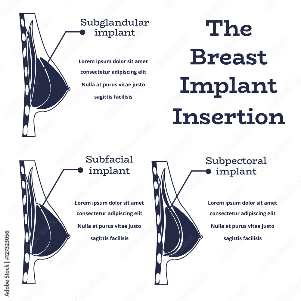 Plastic surgery of silicone breast implant,monochrome vector ...