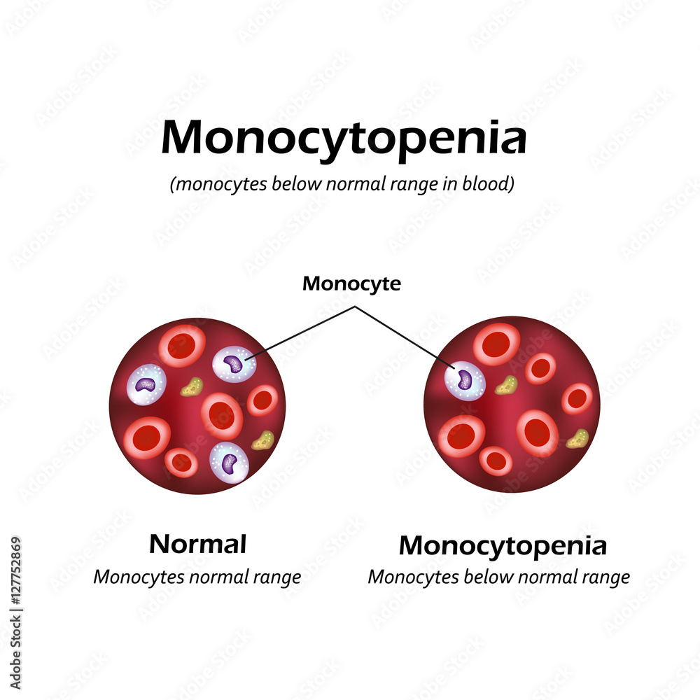 Monocytes below the normal range in the blood. Monocytopenia. Vector ...