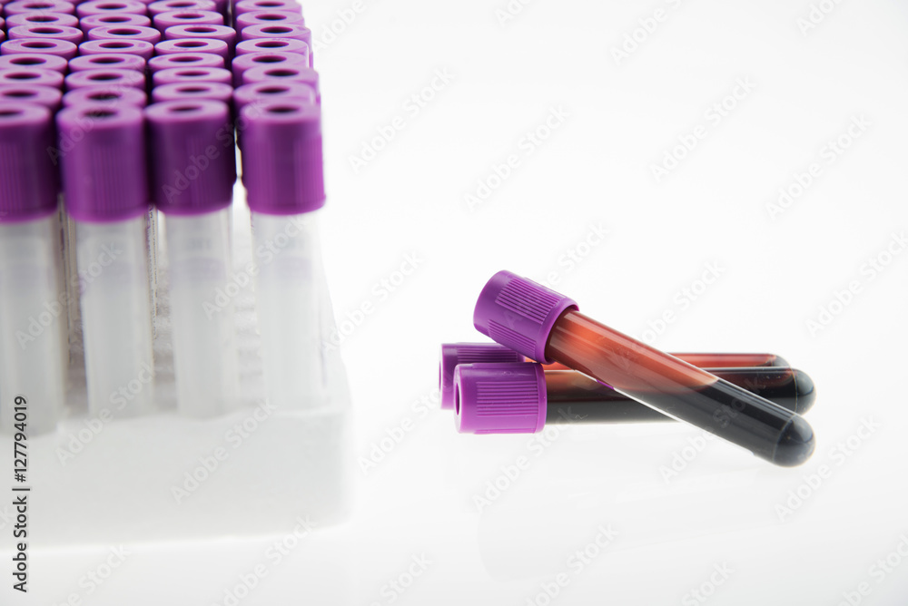 EDTA blood tube for CBC test in laboratory Stock Photo | Adobe Stock