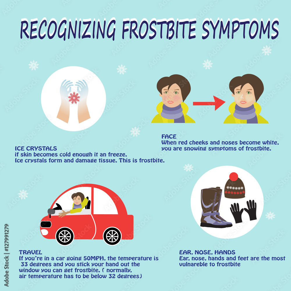recognizing frostbite symptoms Stock Vector | Adobe Stock